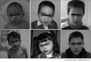 Síndrome de Deleción 22q11 - Psicología Clínica Infantil