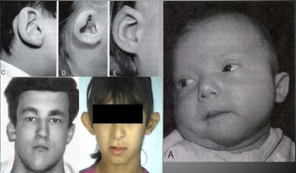 Síndrome de Deleción 22q11 - Psicología Clínica Infantil